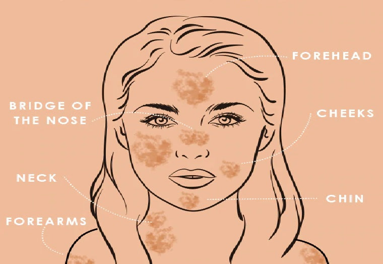 Treatment Of Melasma On Face Stunned The Industry - MesoLyft